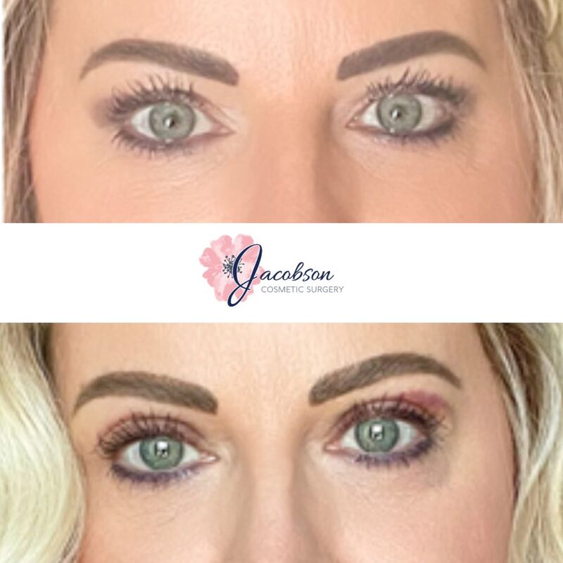 Brow Lift - Jacobson Cosmetic Surgery