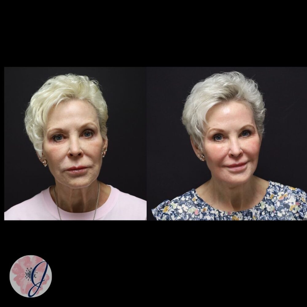 Before and After Galleries - Jacobson Cosmetic Surgery