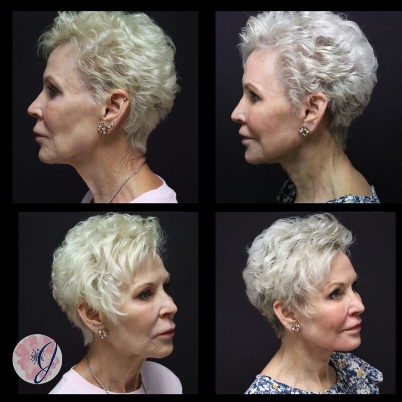 Before and After Galleries - Jacobson Cosmetic Surgery