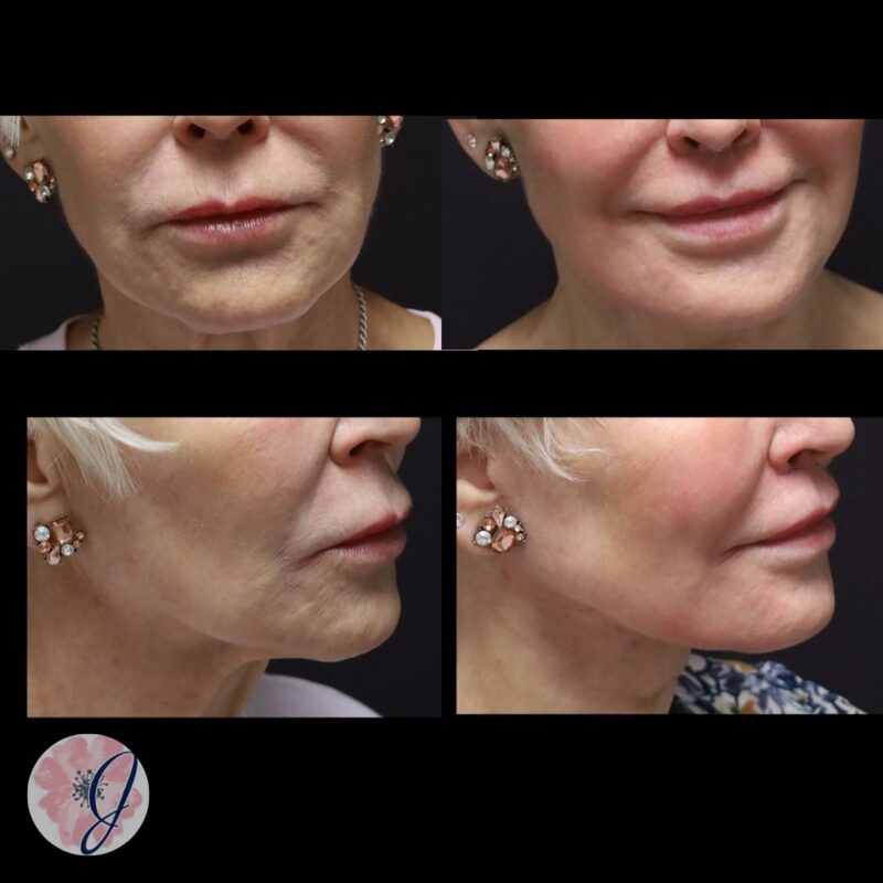 Before and After Galleries - Jacobson Cosmetic Surgery