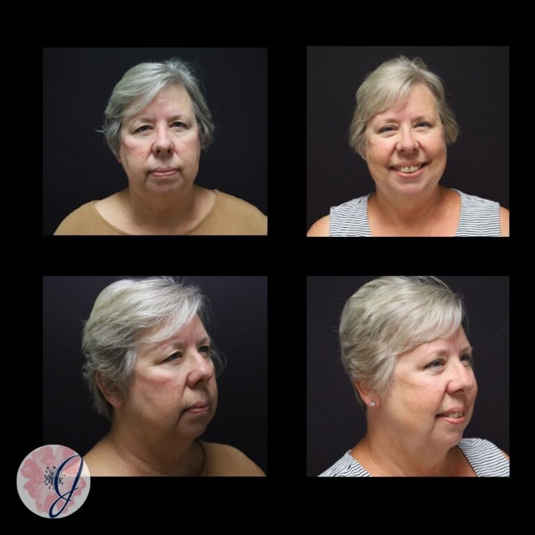 Before and After Galleries - Jacobson Cosmetic Surgery
